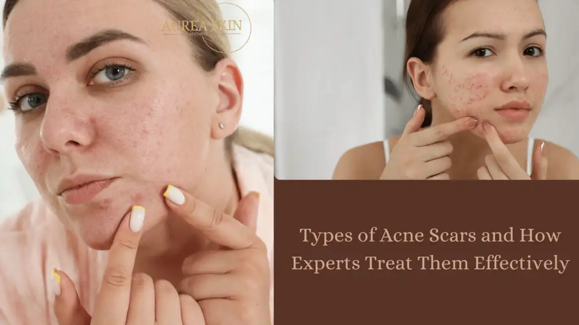 Types of Acne Scars and How Experts Treat Them Effectively – Aurea